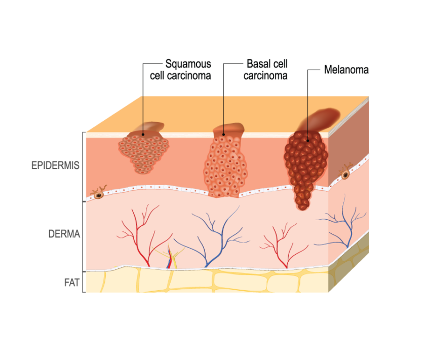 Sun Exposure and Skin Cancer: What You Need to Know— by Camrey Tuttle ...