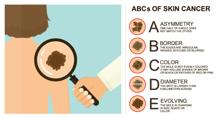 Sun Exposure and Skin Cancer: What You Need to Know— by Camrey Tuttle ...